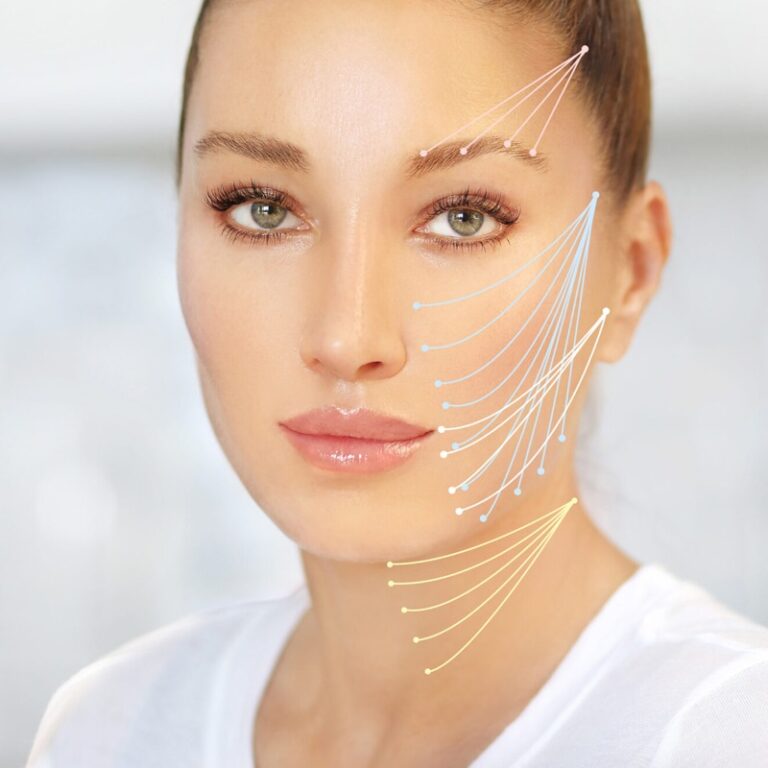 Non Surgical Thread Lift in Mohali